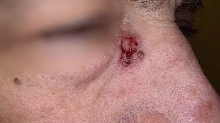 Базалиома: что это, признаки, симптомы, стадии, диагностика и лечение ...